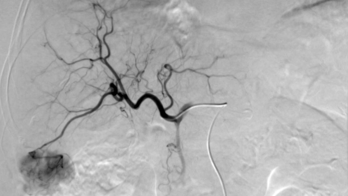 Tiroidectomía: principales detalles | Hospital de Bellvitge